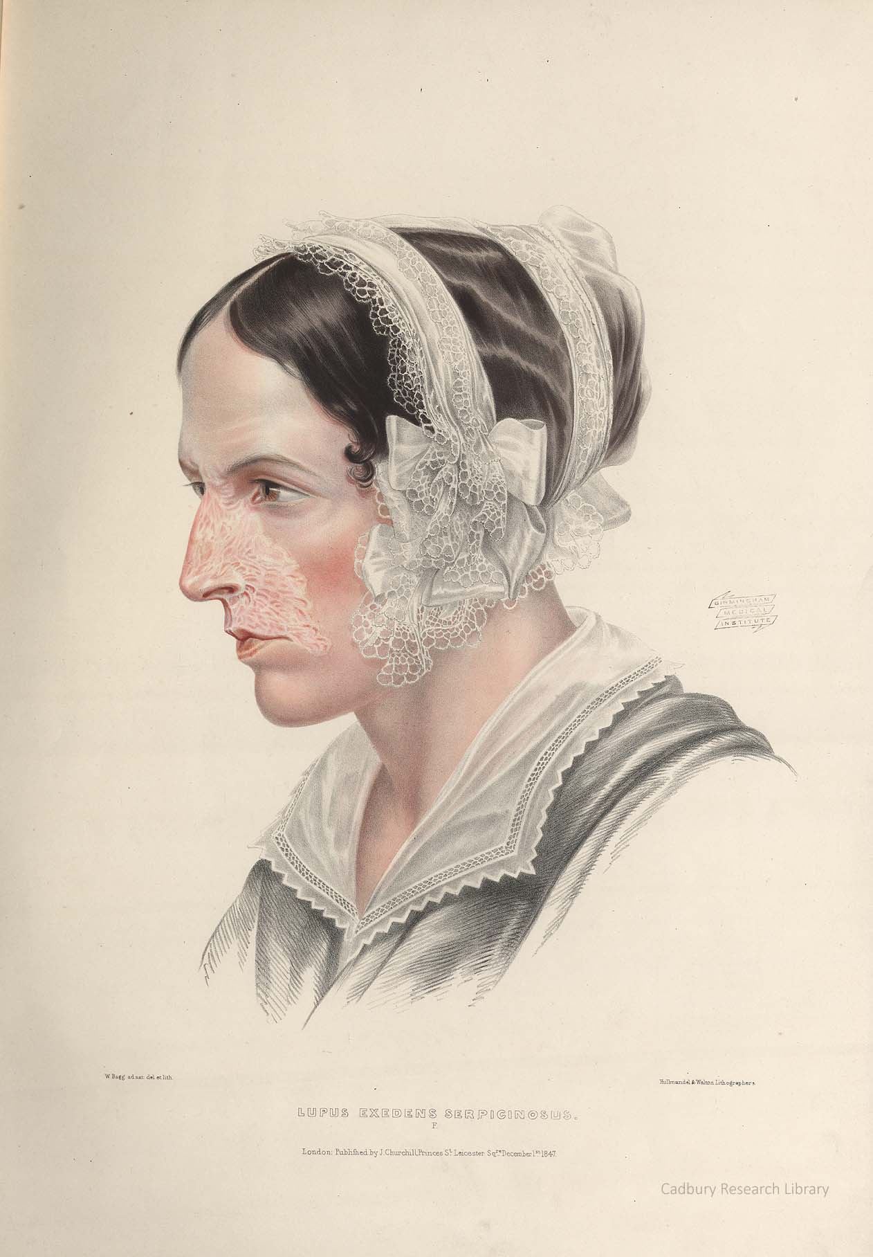Painstaking Portraits of 19th-Century Dermatology Patients
